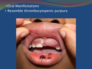 Oral Purpura