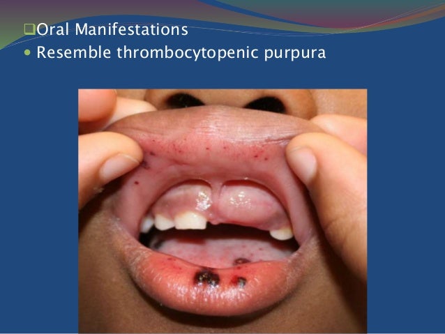 Diseases involving blood platelets