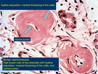 Diseases involving blood vessels of the kidney | PPT