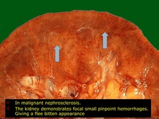 Diseases involving blood vessels of the kidney | PPT
