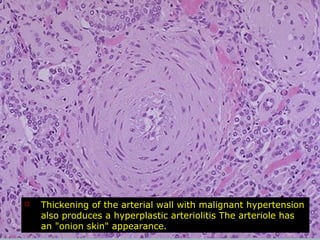 Diseases involving blood vessels of the kidney | PPT