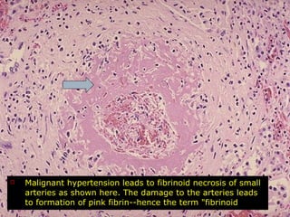 Diseases involving blood vessels of the kidney | PPT
