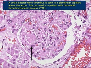 Diseases involving blood vessels of the kidney | PPT