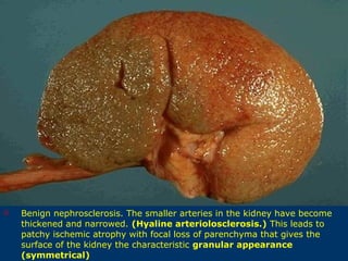 Diseases involving blood vessels of the kidney | PPT