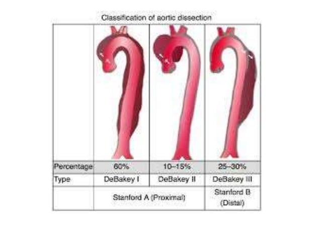 Diseases of aorta | PPTX | Heart and Cardiovascular Diseases | Diseases and Conditions