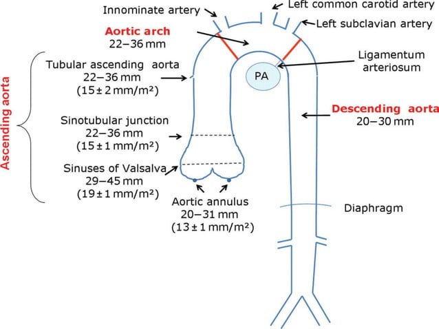 Diseases of aorta | PPTX | Heart and Cardiovascular Diseases | Diseases and Conditions
