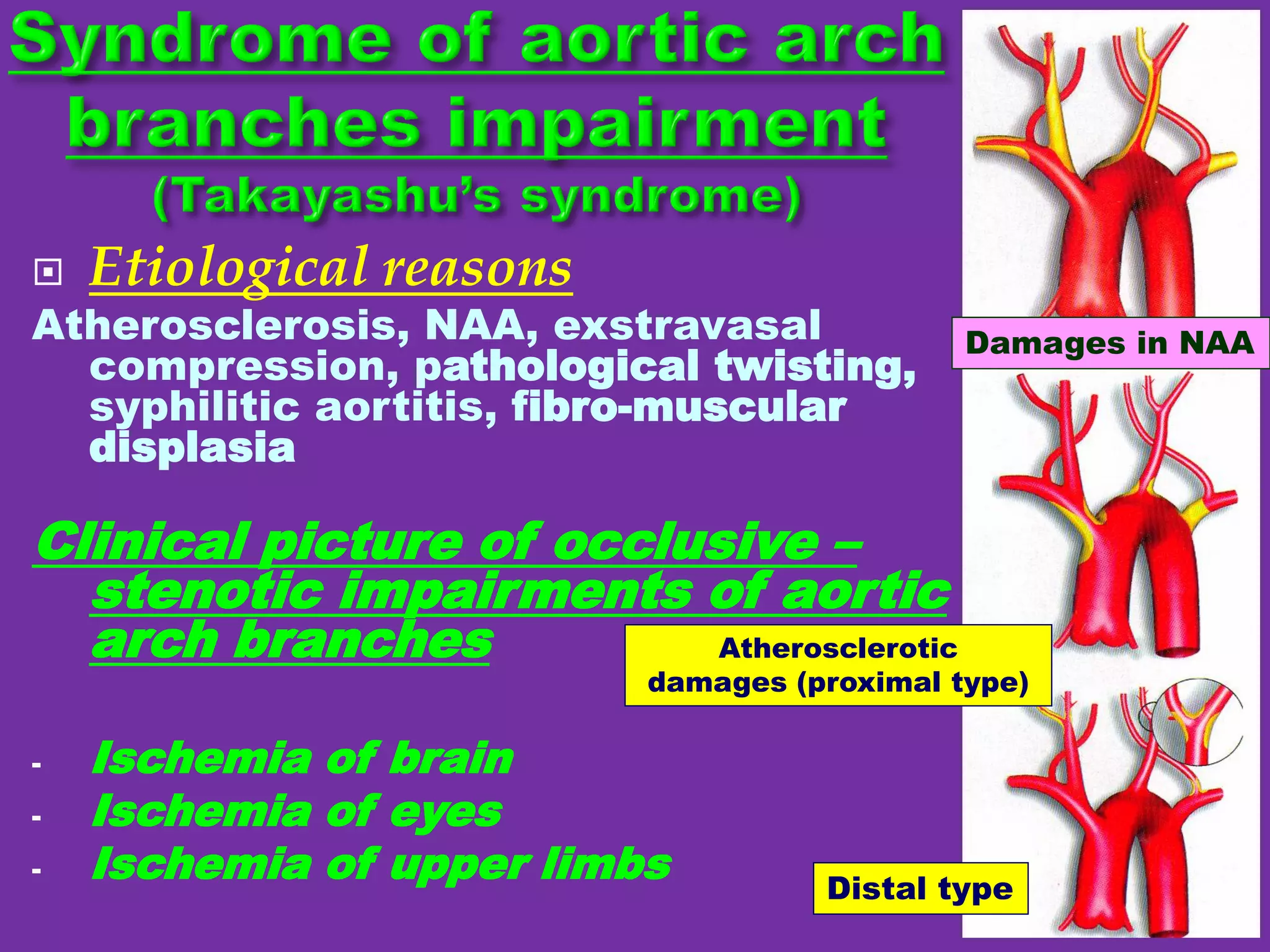 Diseases of aorta and its branches (lecture vasilevsky v.p.) | PDF