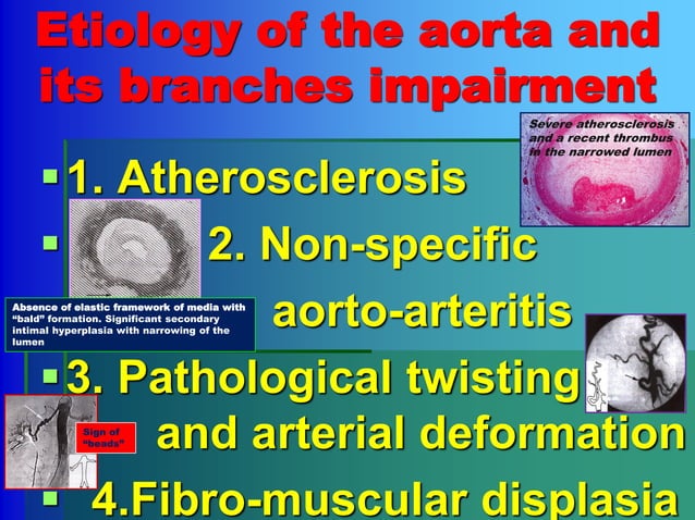 Diseases of aorta and its branches (lecture vasilevsky v.p.) | PDF | Heart and Cardiovascular ...