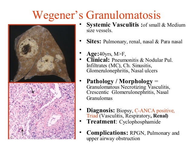 Diseases of blood vessels