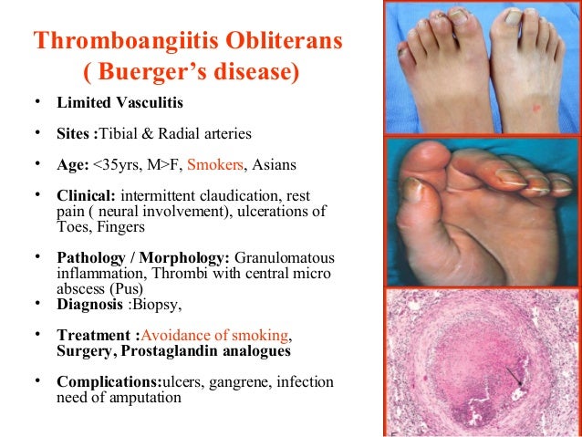 Diseases of blood vessels