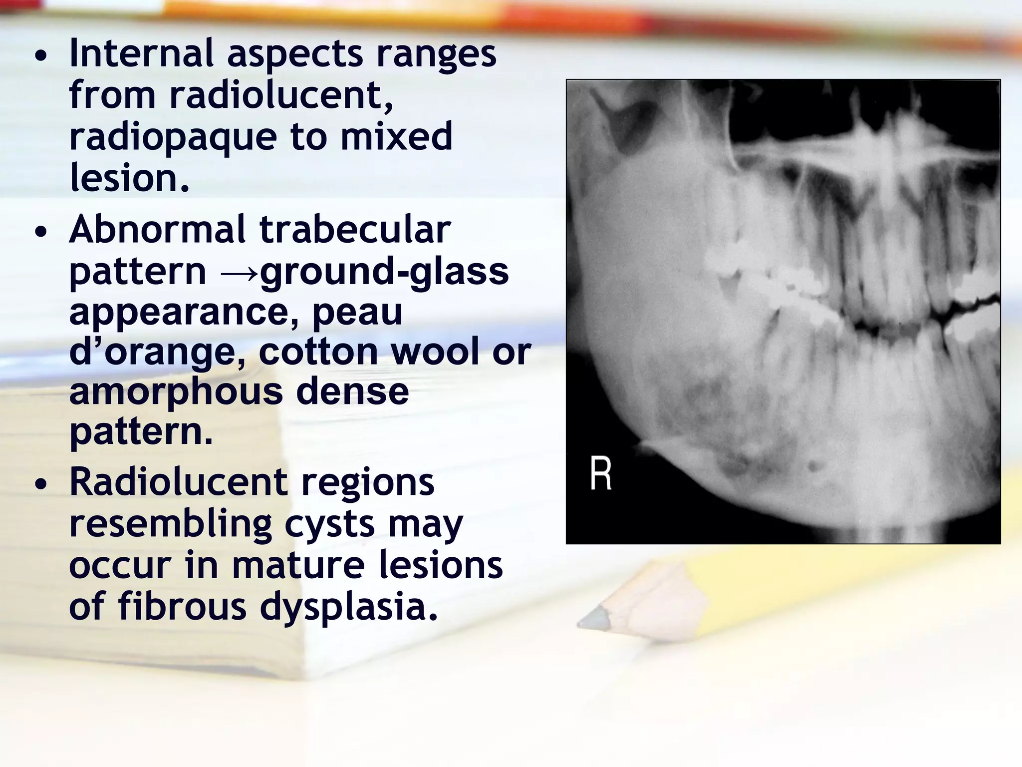 Diseases of bone manifested in the jaws | PPT