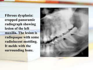 Diseases of bone manifested in the jaws | PPT