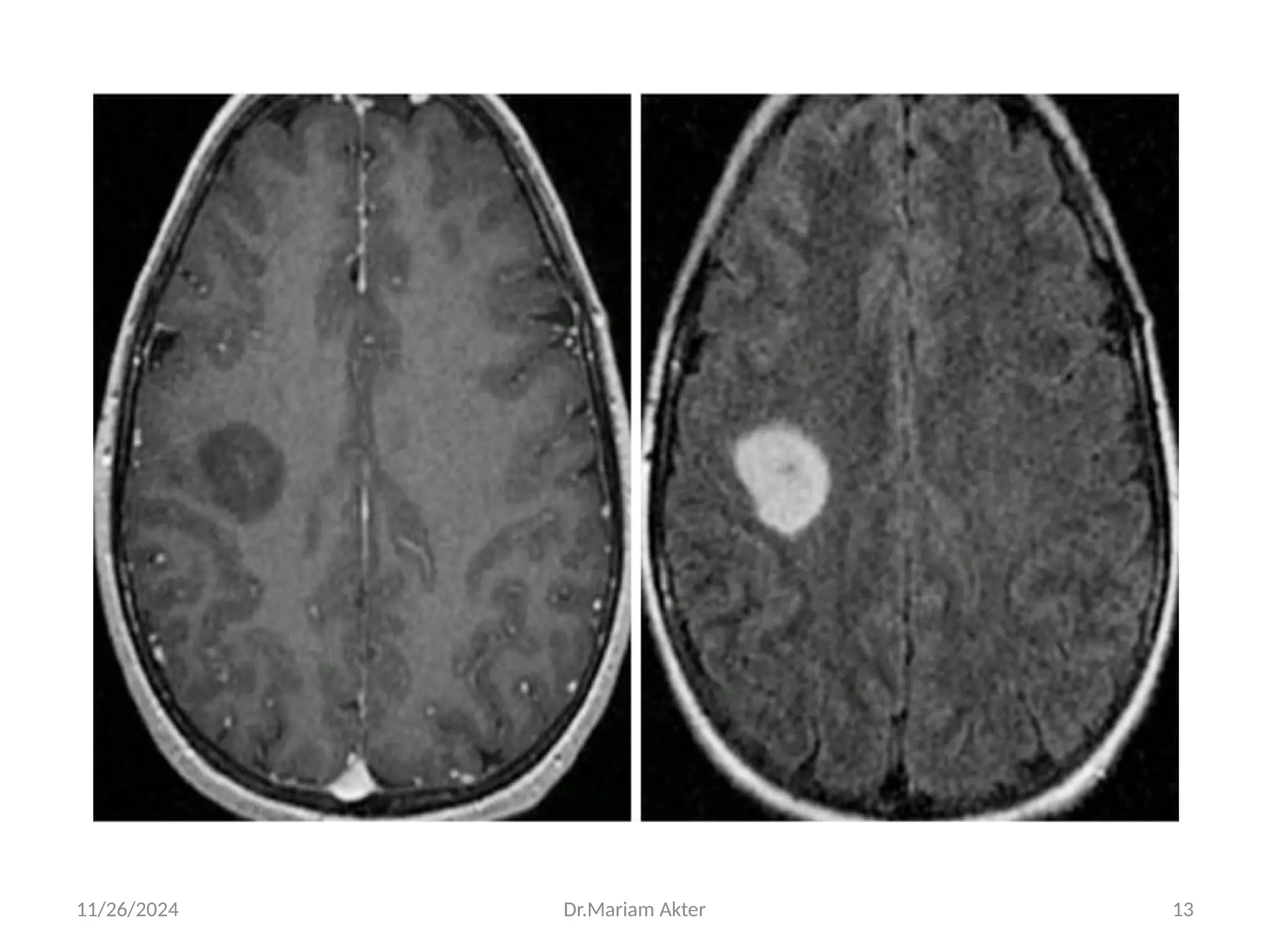 Diseases of Brain tumer classification of brain tumor | PPT