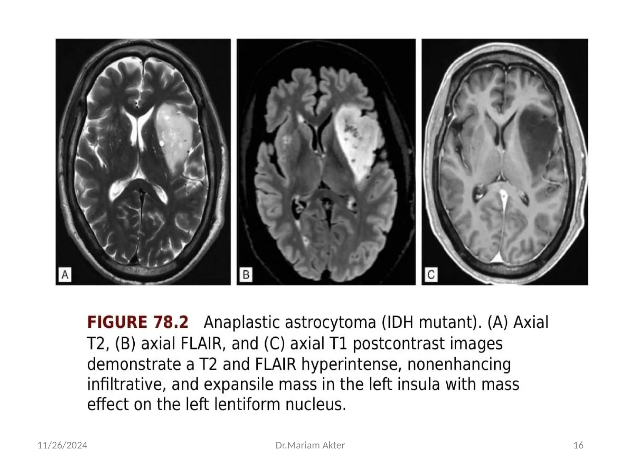 Diseases of Brain tumer classification of brain tumor | PPT