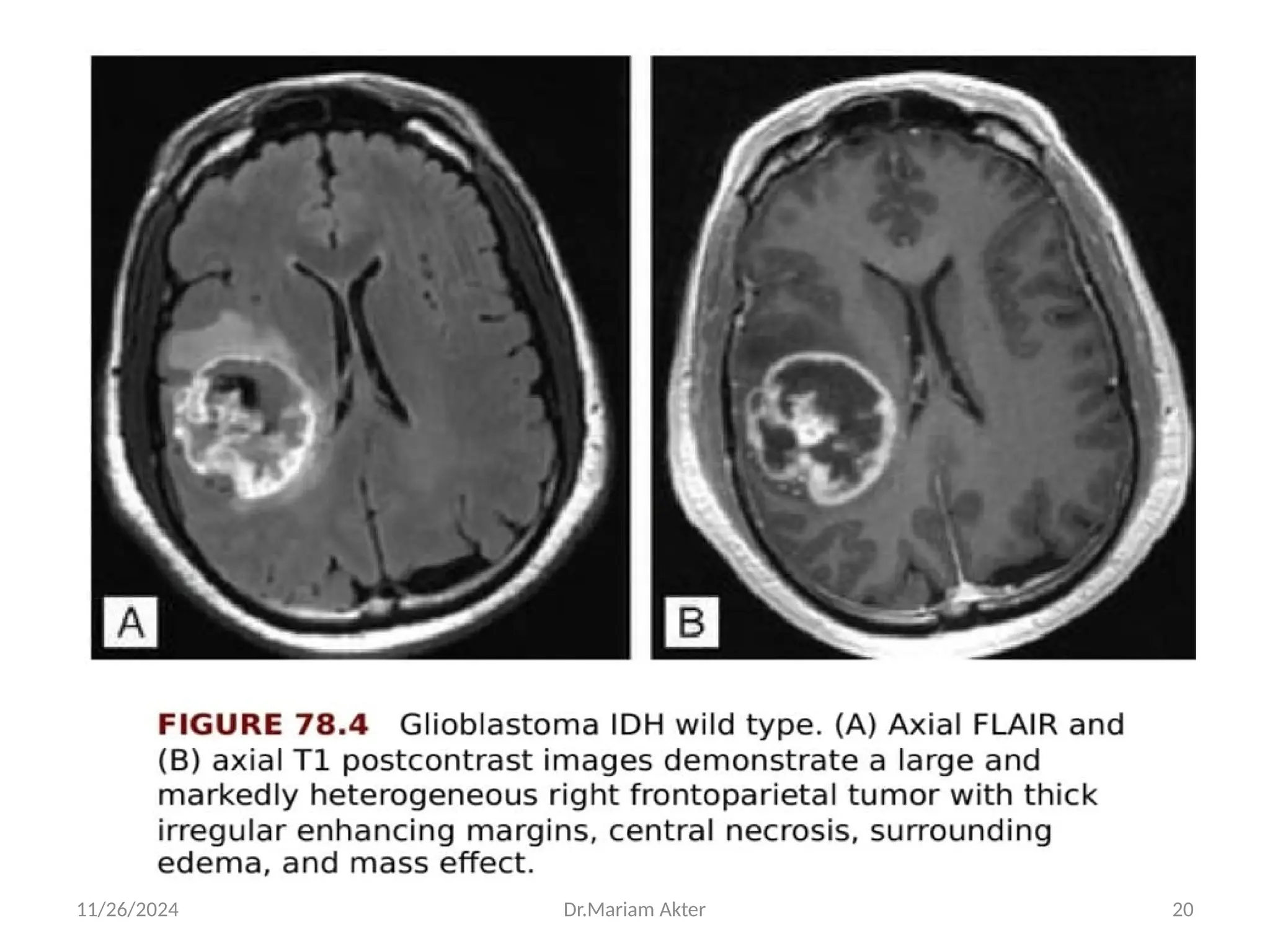 Diseases of Brain tumer classification of brain tumor | PPT