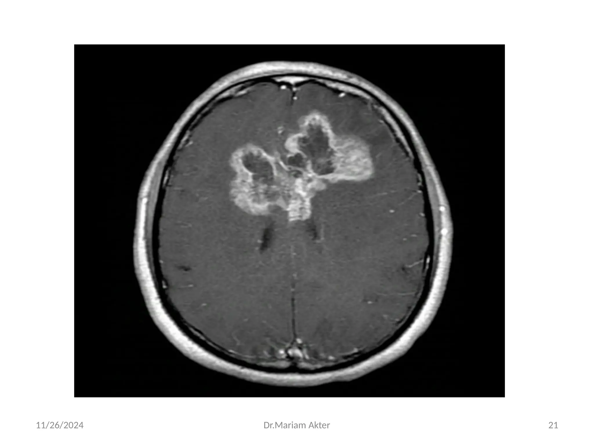 Diseases of Brain tumer classification of brain tumor | PPT