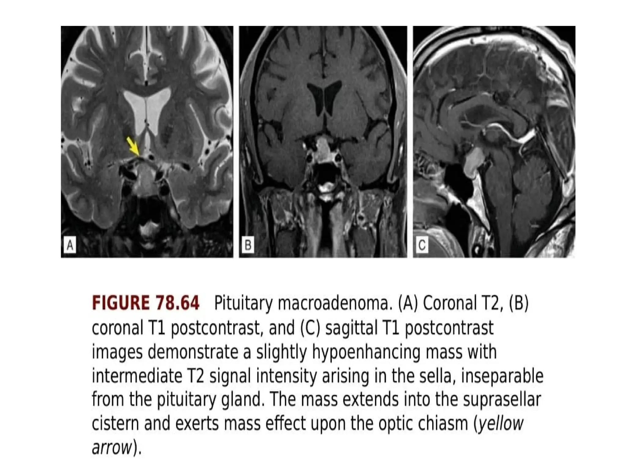 Diseases of Brain tumer classification of brain tumor | PPT
