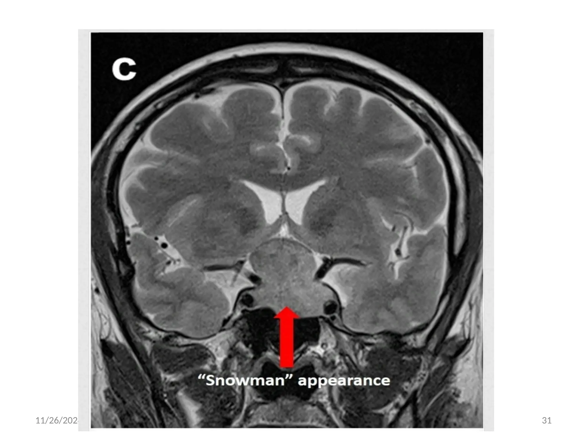 Diseases of Brain tumer classification of brain tumor | PPT