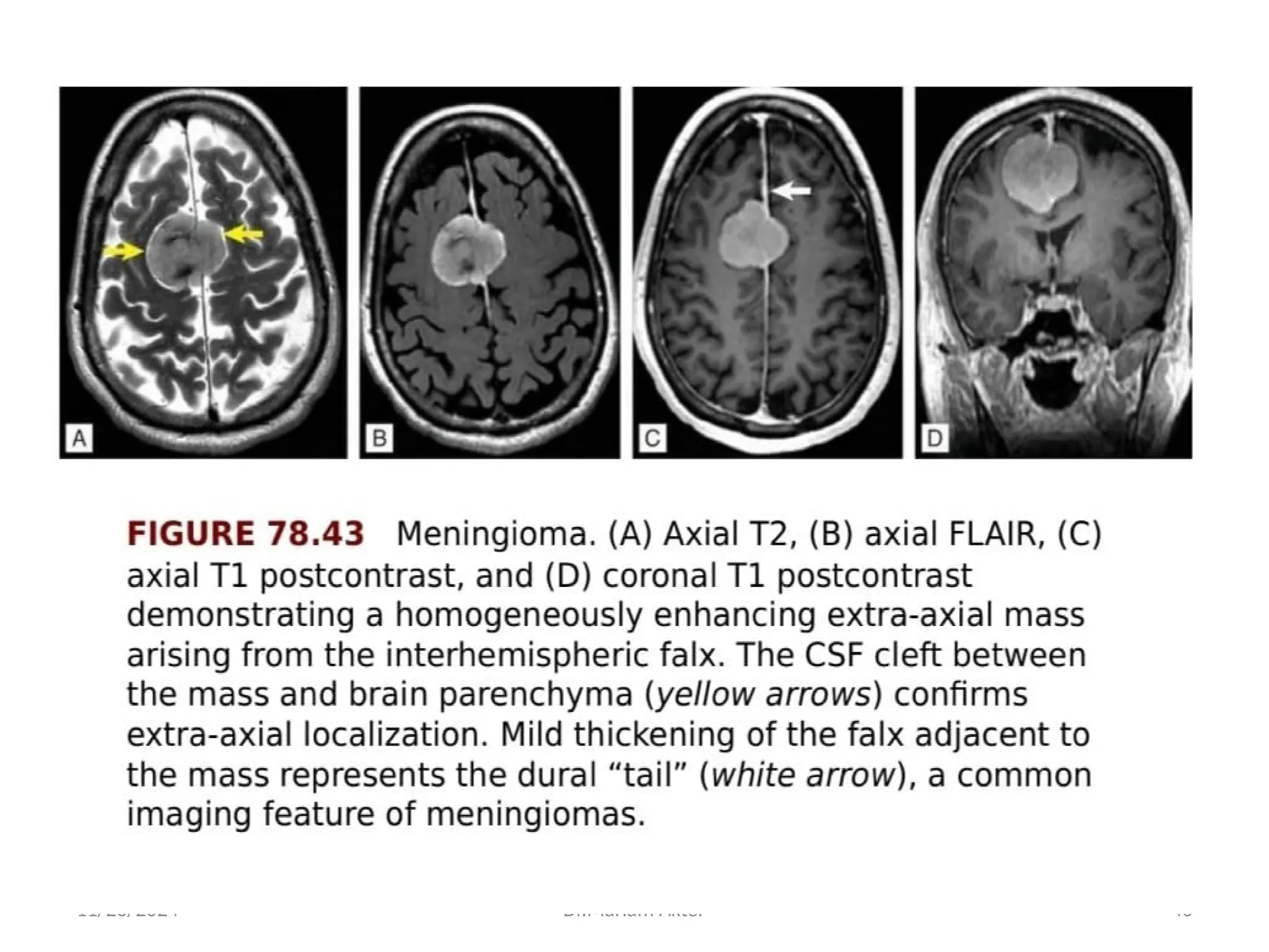Diseases of Brain tumer classification of brain tumor | PPT