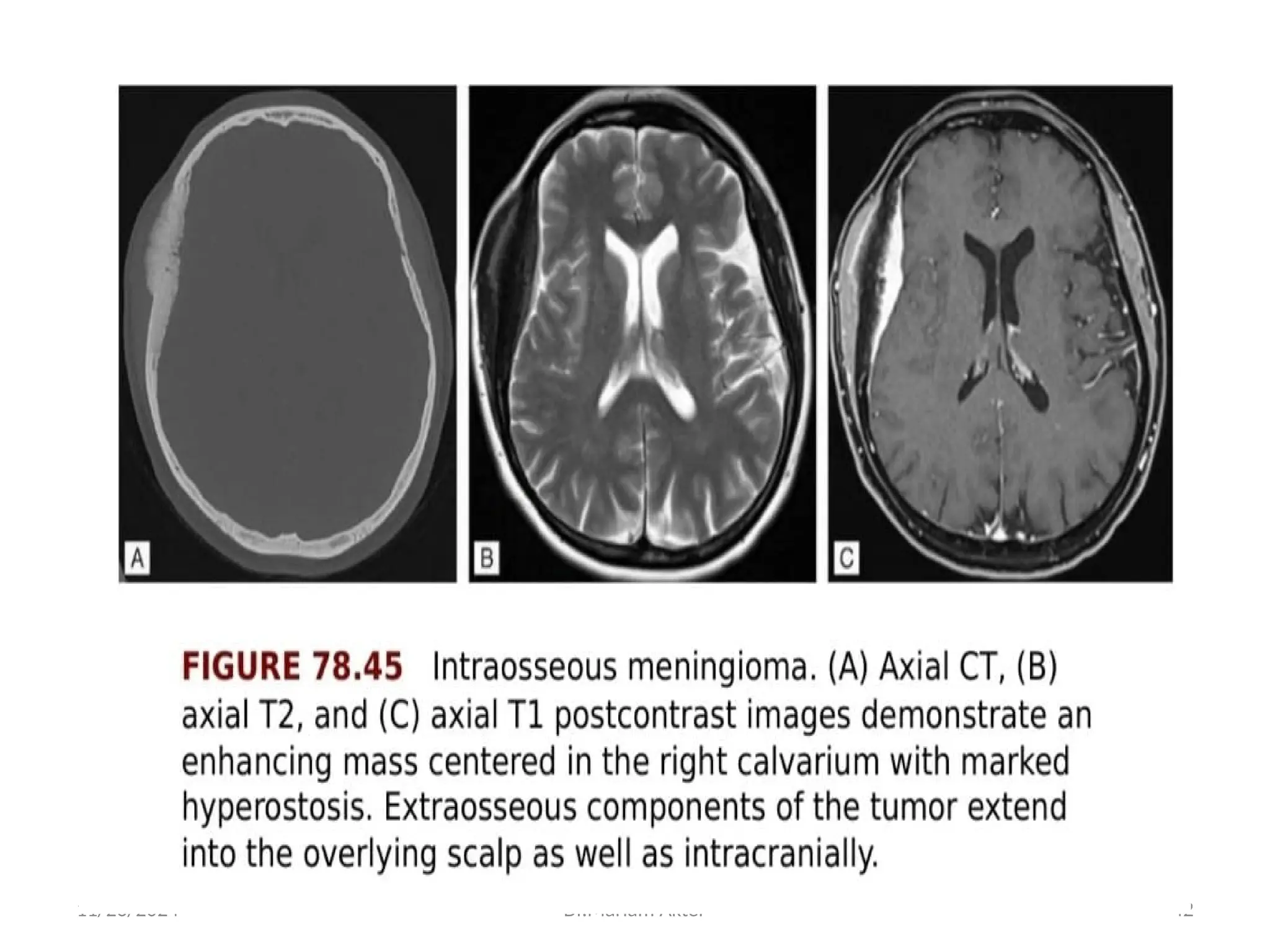 Diseases of Brain tumer classification of brain tumor | PPT