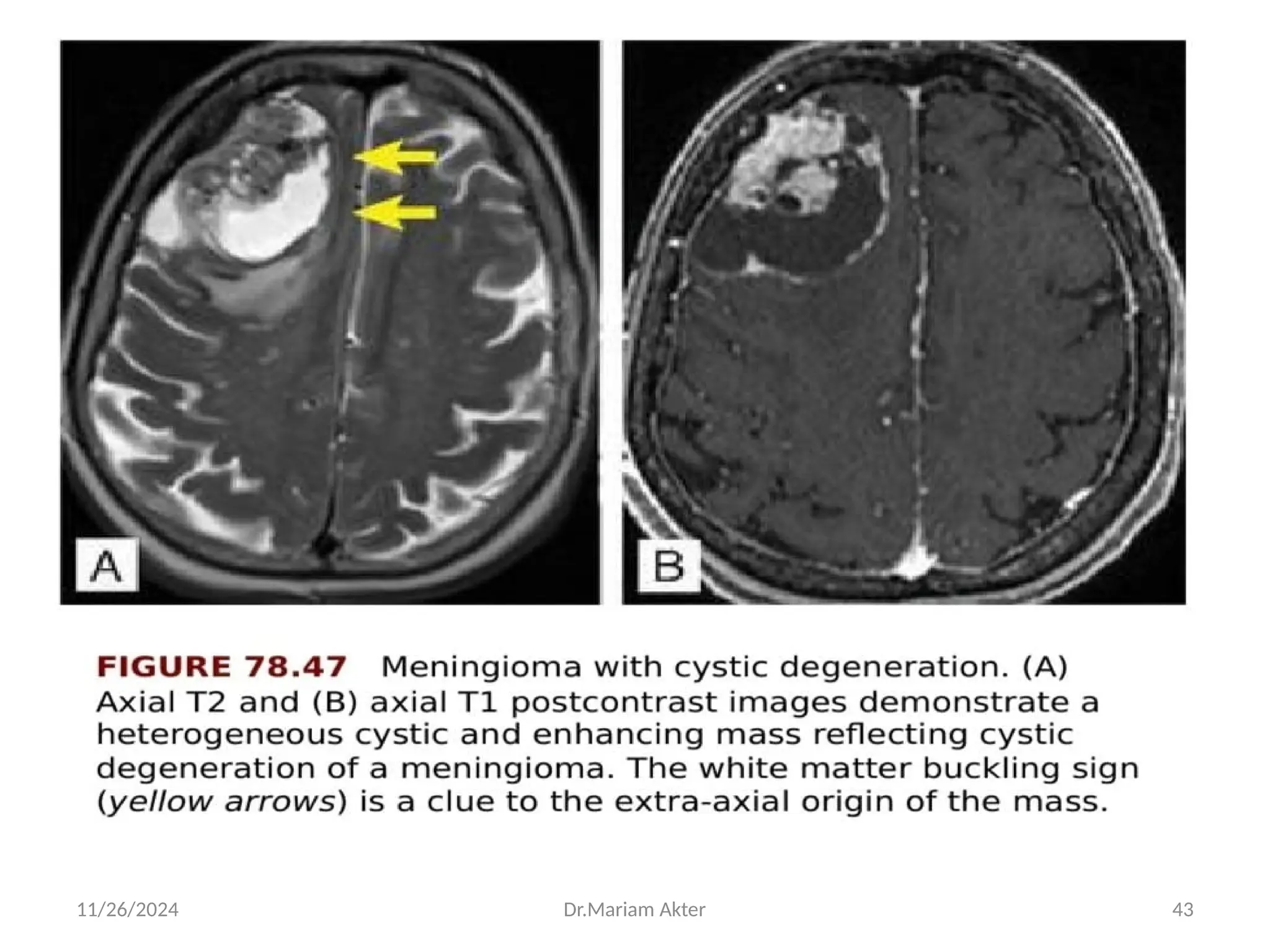 Diseases of Brain tumer classification of brain tumor | PPT