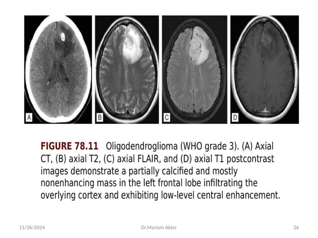 Diseases of Brain tumer classification of brain tumor | PPT