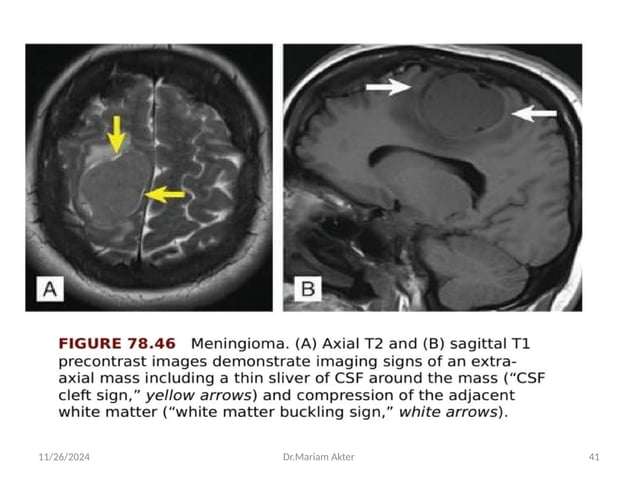 Diseases of Brain tumer classification of brain tumor | PPT