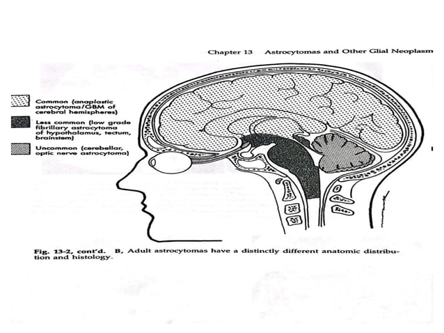 Diseases of Brain tumer classification of brain tumor | PPT