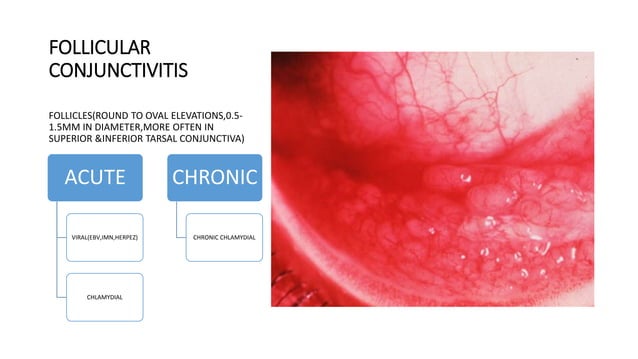 Diseases of conjunctiva ppt ophthalmology | PPTX | Eye and Vision ...
