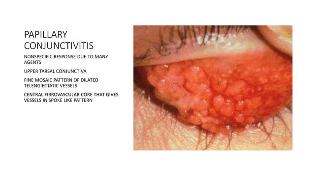 Diseases of conjunctiva ppt ophthalmology | PPTX | Eye and Vision Conditions | Diseases and ...
