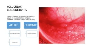 Conjunctival Follicles