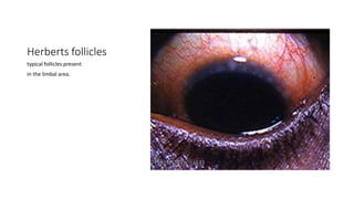Limbal Follicles