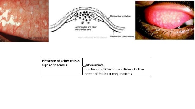 Diseases of conjunctiva ppt ophthalmology