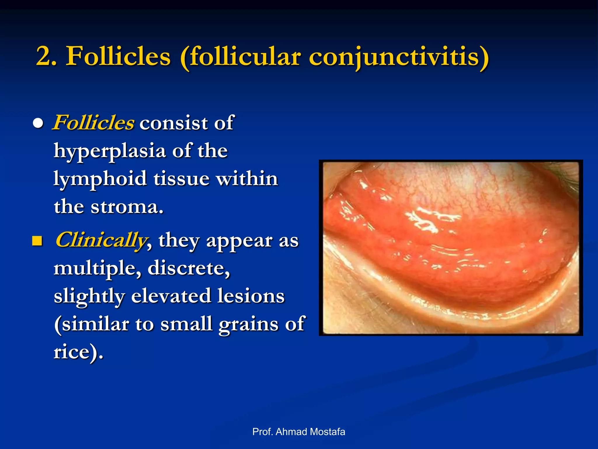 Diseases of conjunctiva | PPT