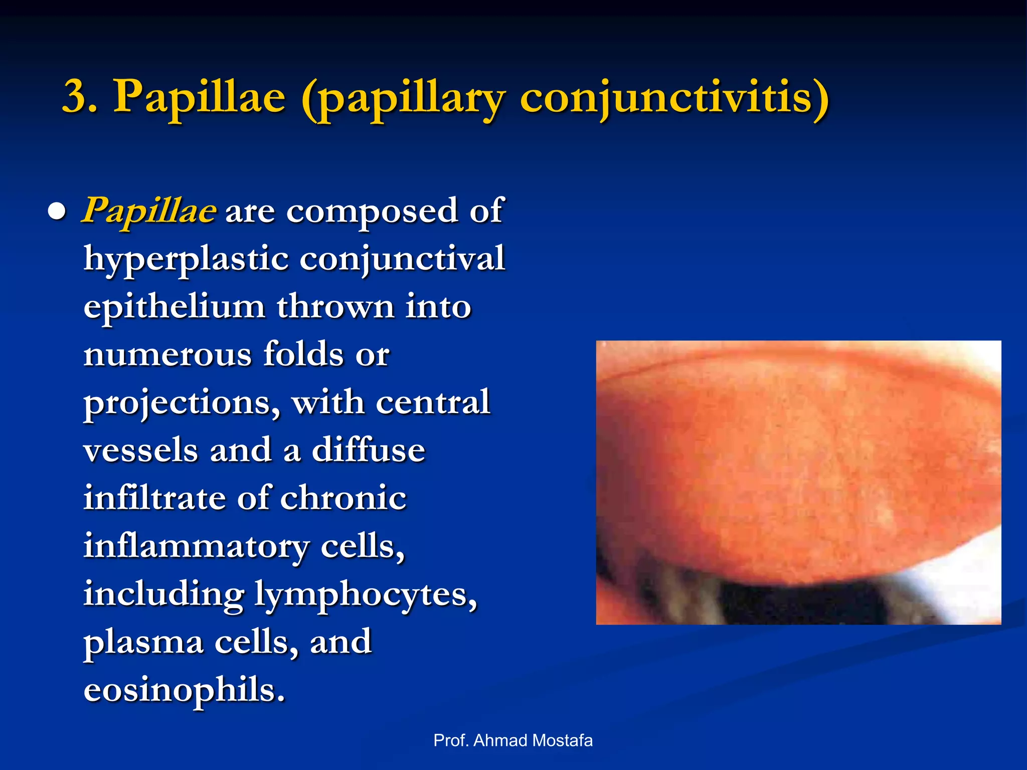 Diseases of conjunctiva | PPT