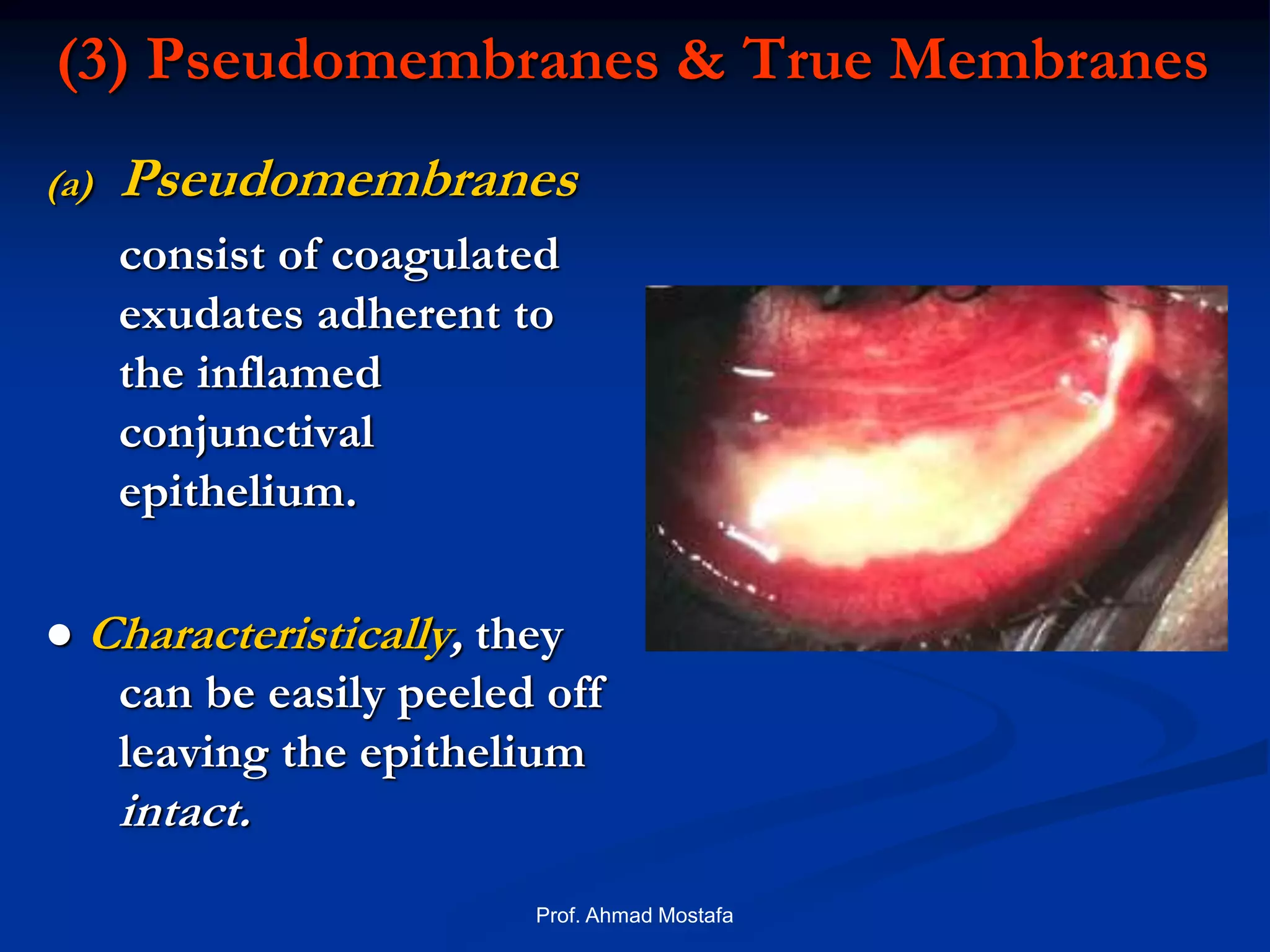 Diseases of conjunctiva | PPT