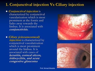 Diseases of conjunctiva | PPT