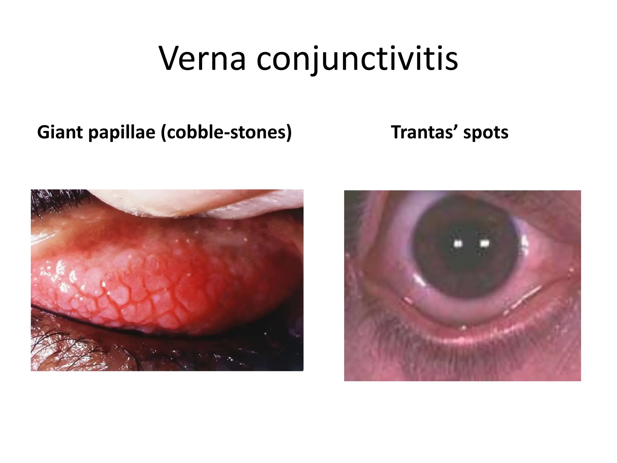 Diseases of Conjunctiva.pptx