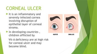 DISEASES OF CORNEA. Including keratitis | PPTX
