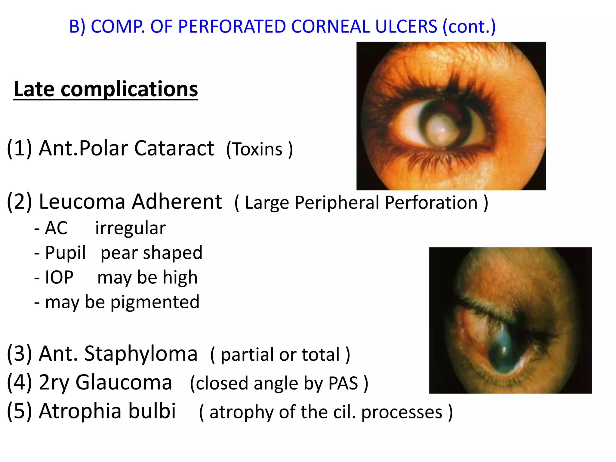 DISEASES OF CORNEA---5.pptx
