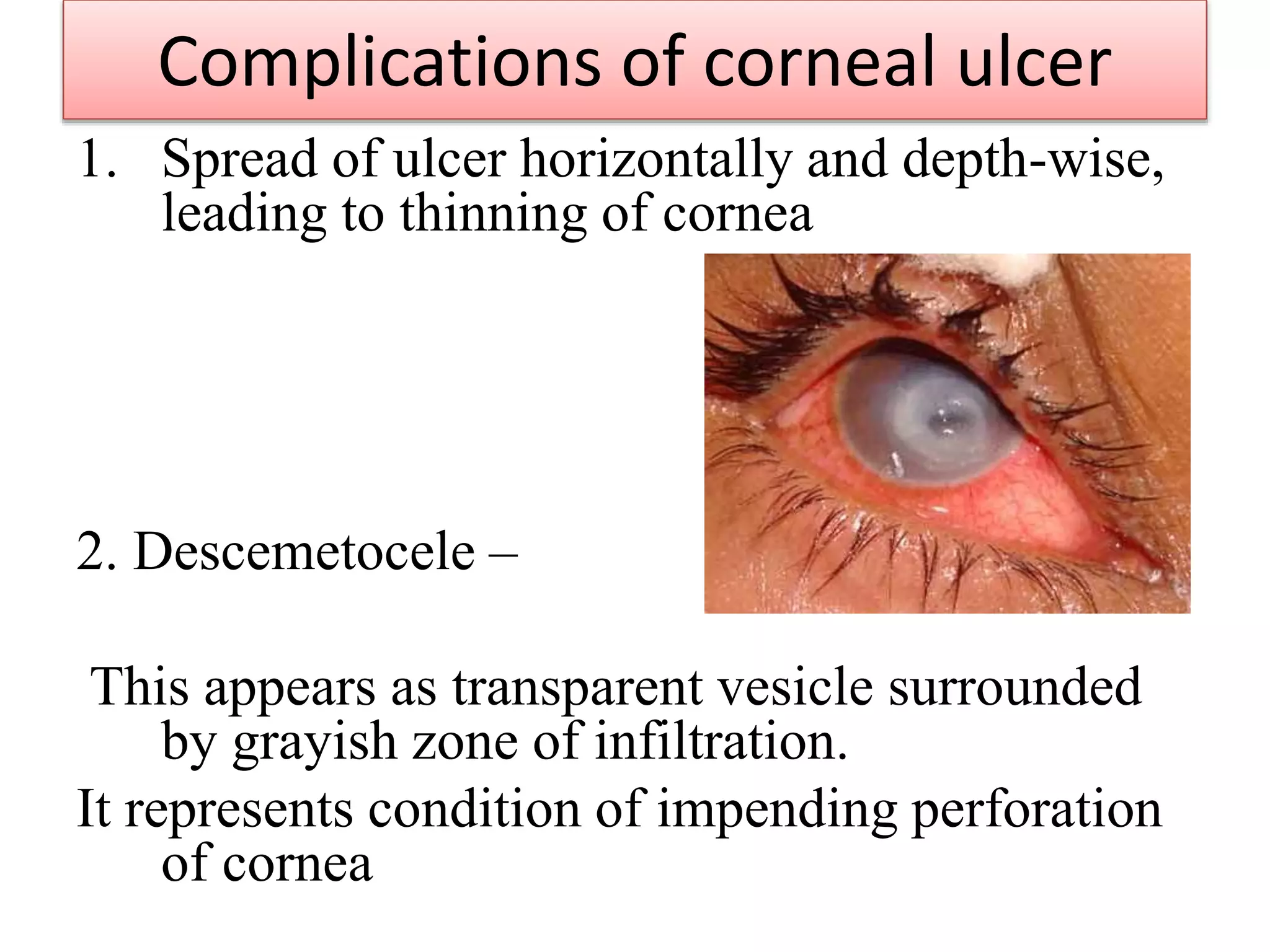 DISEASES OF CORNEA---5.pptx