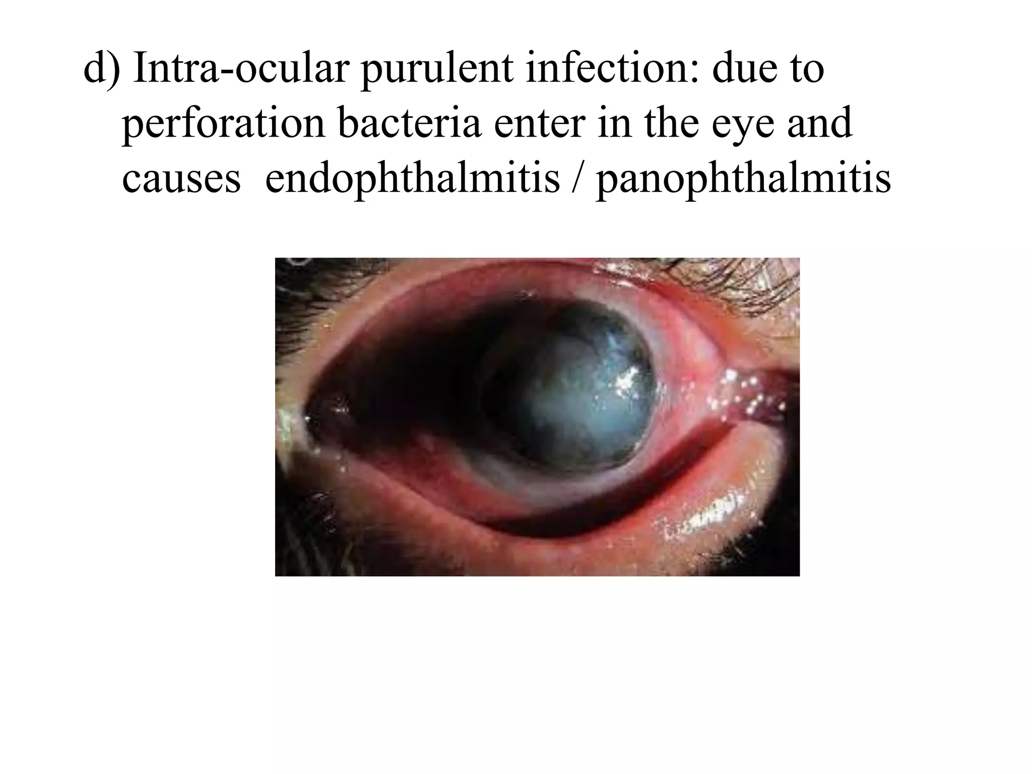 DISEASES OF CORNEA---5.pptx