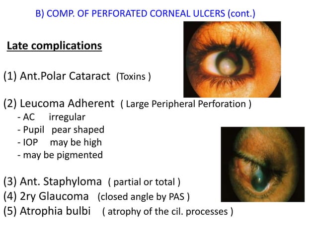 DISEASES OF CORNEA---5.pptx | Eye and Vision Conditions | Diseases and ...