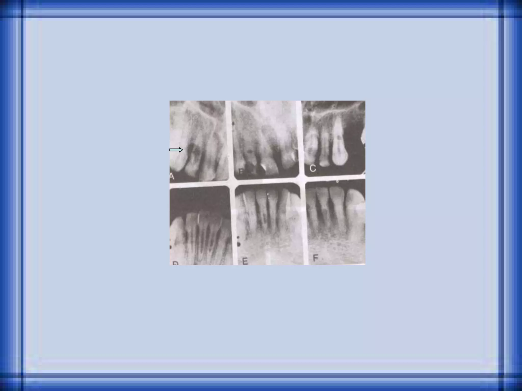 DISEASES OF DENTAL PULP AND PERI RADICULAR TISSUES | PPT