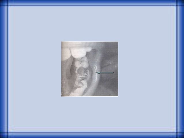 DISEASES OF DENTAL PULP AND PERI RADICULAR TISSUES | PPT