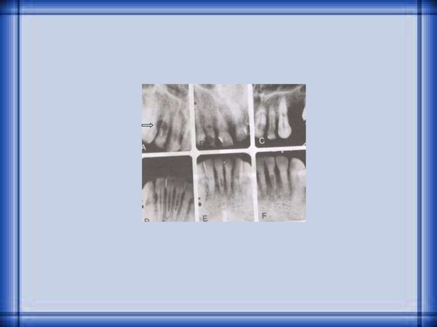 DISEASES OF DENTAL PULP AND PERI RADICULAR TISSUES | PPT