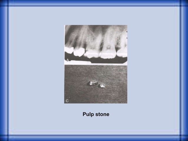 DISEASES OF DENTAL PULP AND PERI RADICULAR TISSUES | PPT