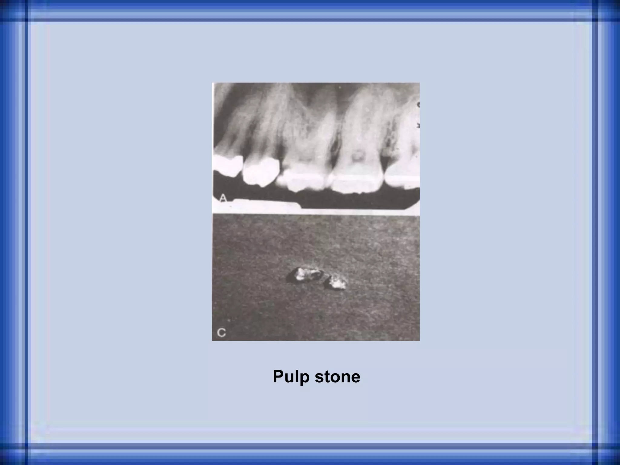 DISEASES OF DENTAL PULP AND PERI RADICULAR TISSUES.ppt