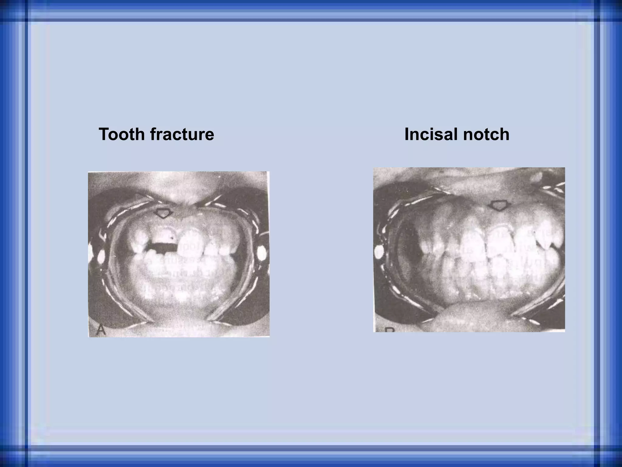 DISEASES OF DENTAL PULP AND PERI RADICULAR TISSUES.ppt