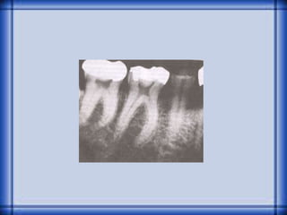 DISEASES OF DENTAL PULP AND PERI RADICULAR TISSUES.ppt